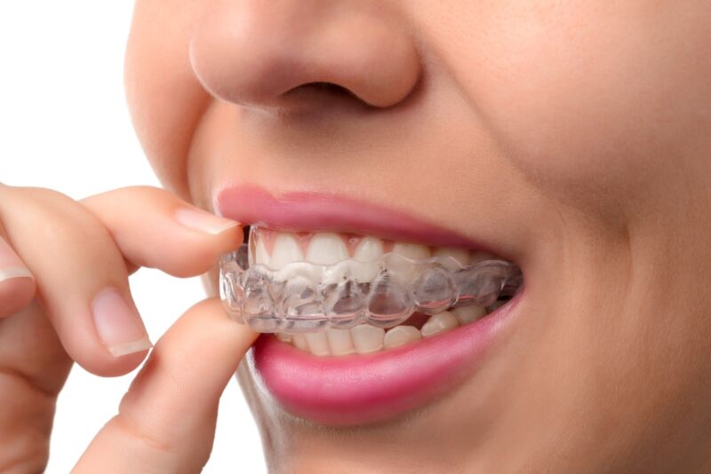 Invisalign: todas las respuestas a las dudas más frecuentes | Clínica ...