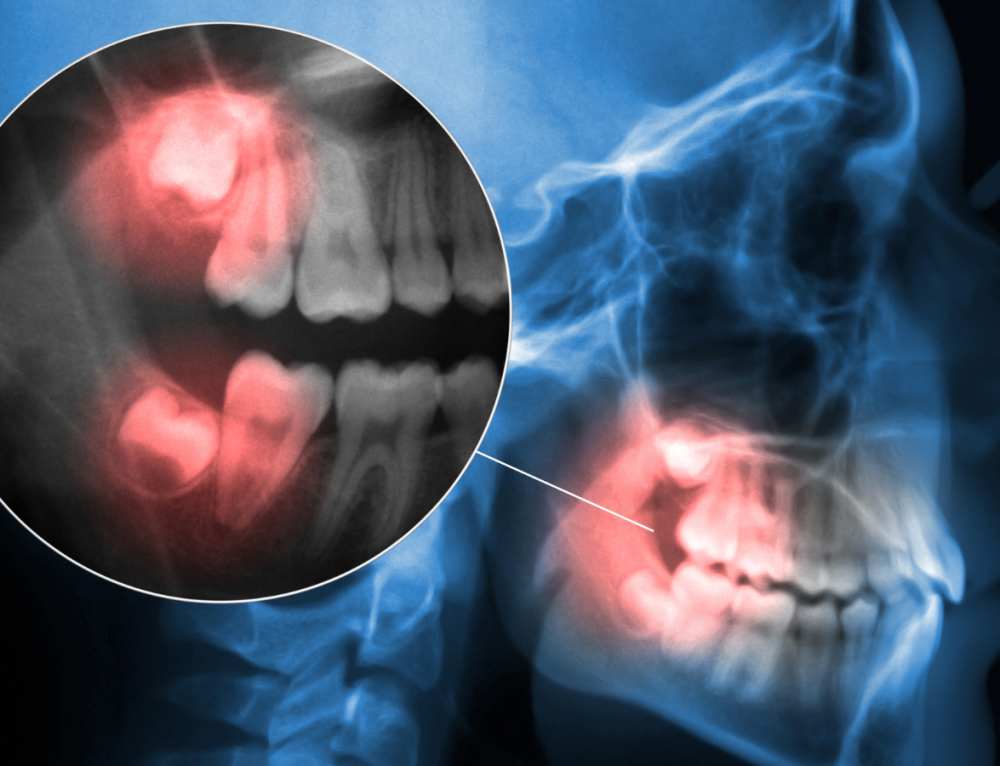 Tengo infección en una muela: Causas, complicaciones y tratamientos ...